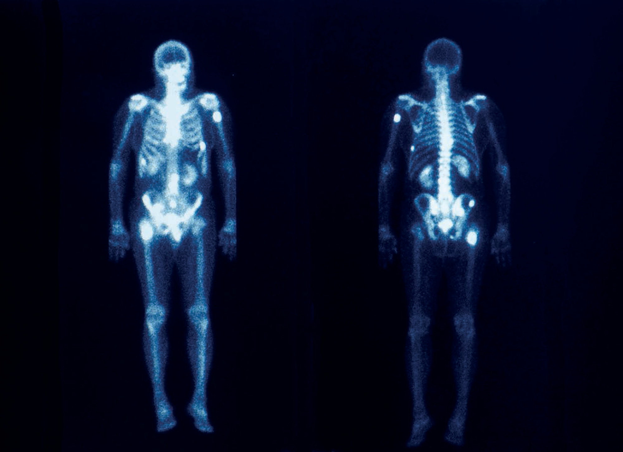 Nuclear Medicine of The Skeletal System - Aristotle CE - Online ...